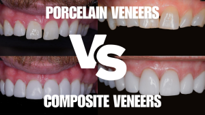 Dentist's Guide to Porcelain vs Composite Veneers | Pros & Cons